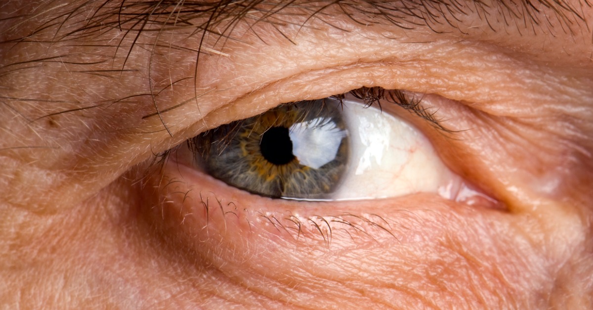 Dermatochalasis - Eye Consultants of Atlanta